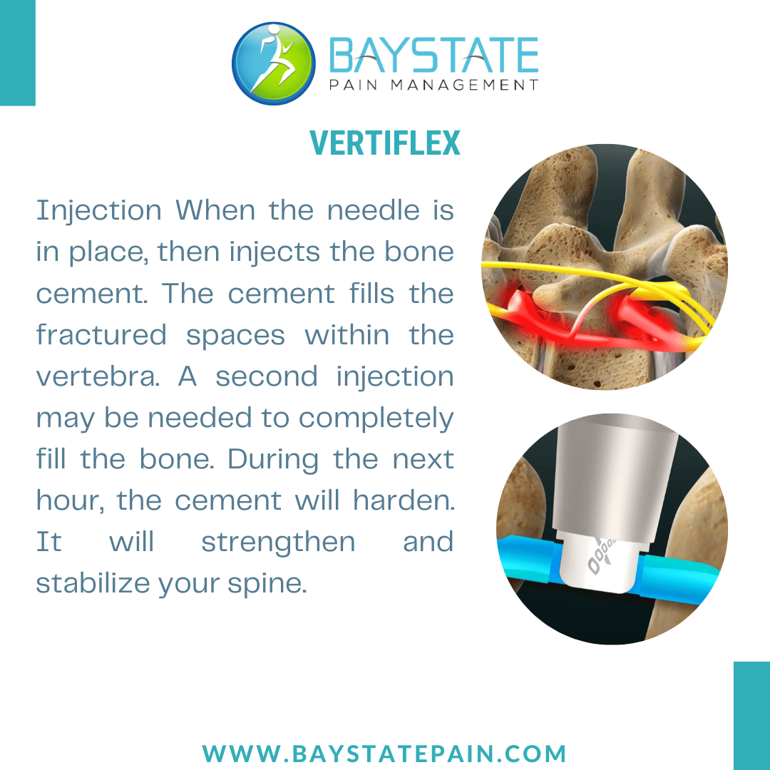 Vertiflex | Bay State Pain Associates
